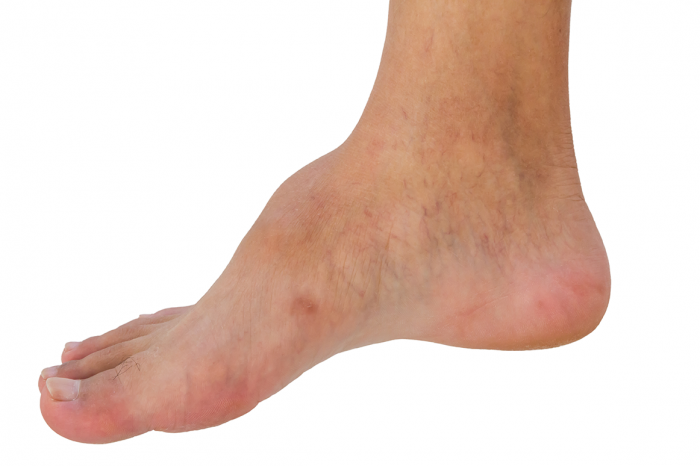 Hohlfuss - Der Fussexperte