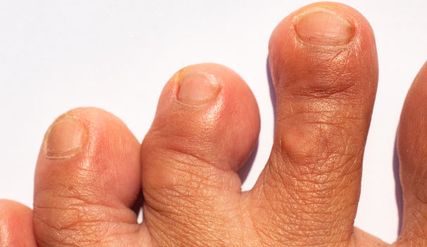 Hammerzeh / Krallenzeh - Der Fussexperte