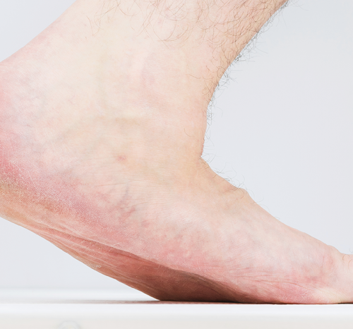 Plattfuss senkfuss - Der Fussexperte